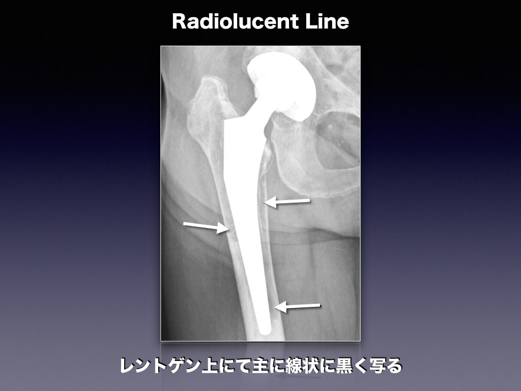 Radiolucent Lineとは │ 整形外科のいろいろ