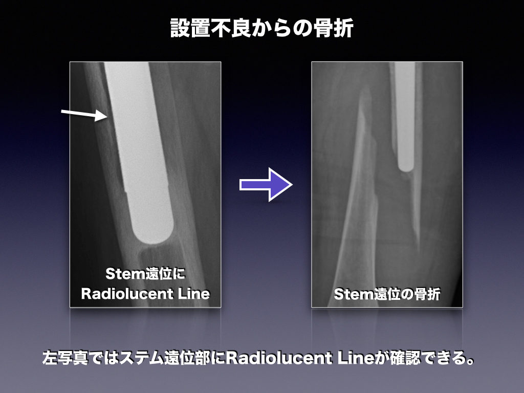 Radiolucent Lineとは │ 整形外科のいろいろ