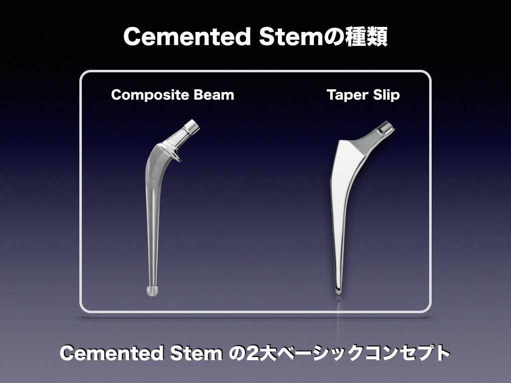ステムの基礎知識5 （Cemented Stemの種類） │ 整形外科のいろいろ