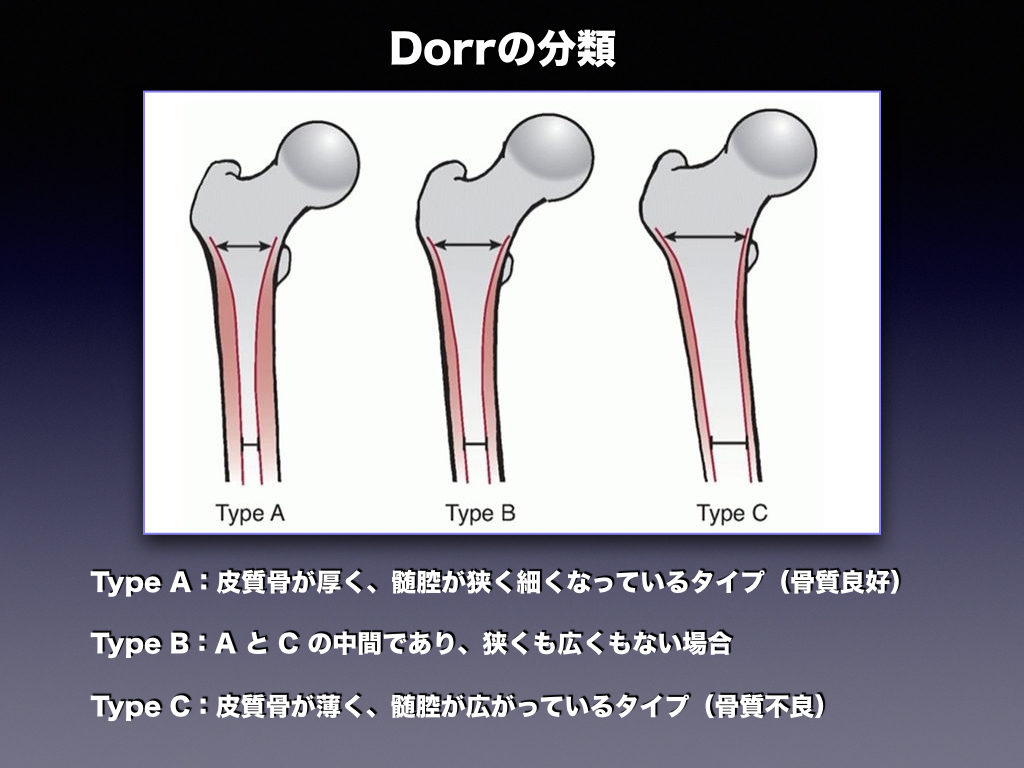 大腿骨の髄腔形状（Dorrの分類） │ 整形外科のいろいろ