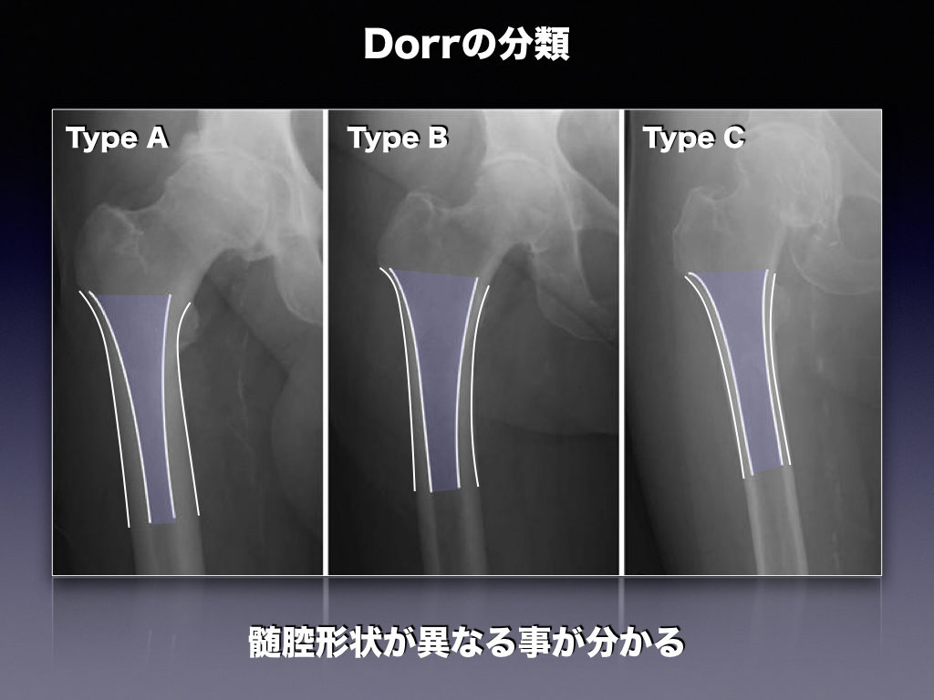 大腿骨の髄腔形状（Dorrの分類） │ 整形外科のいろいろ