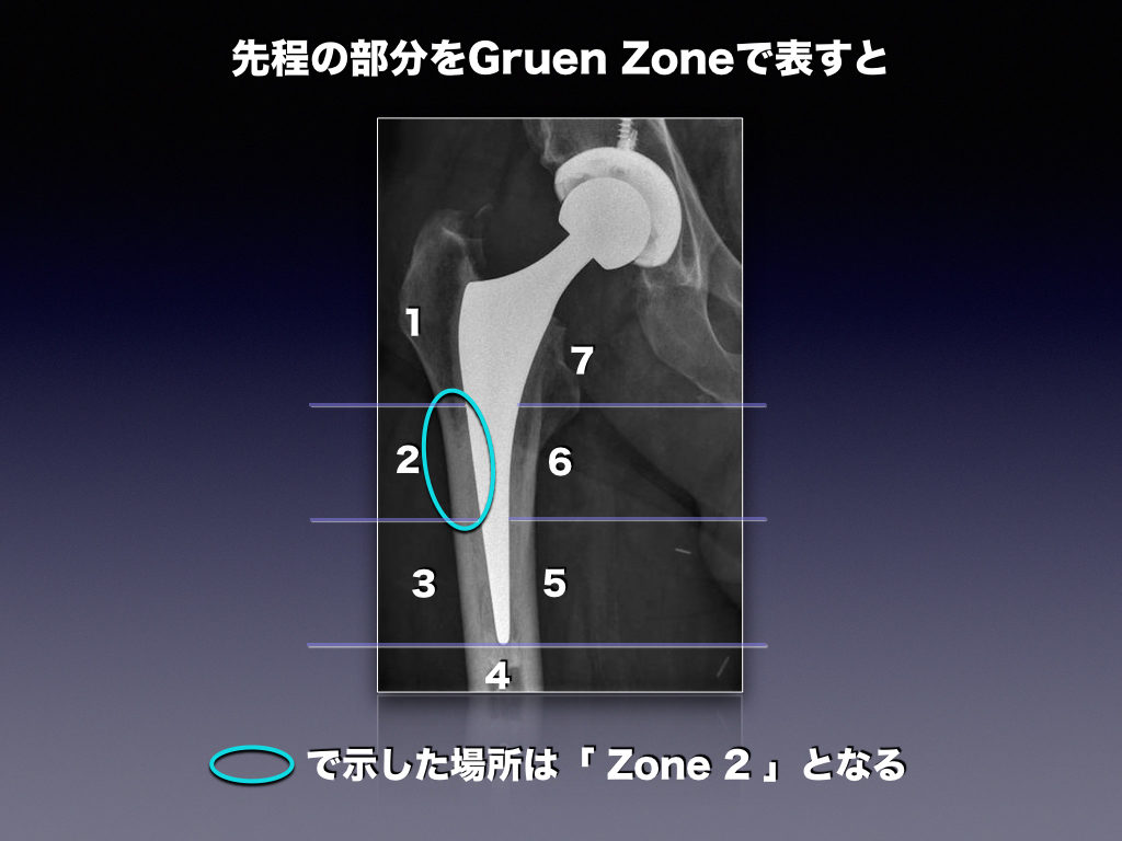 Hip Prosthesis Zoneを知ろう │ 整形外科のいろいろ