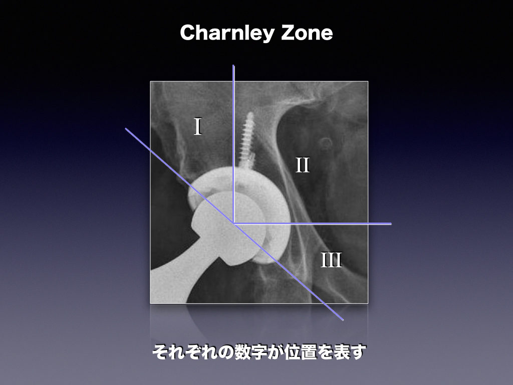Hip Prosthesis Zoneを知ろう │ 整形外科のいろいろ