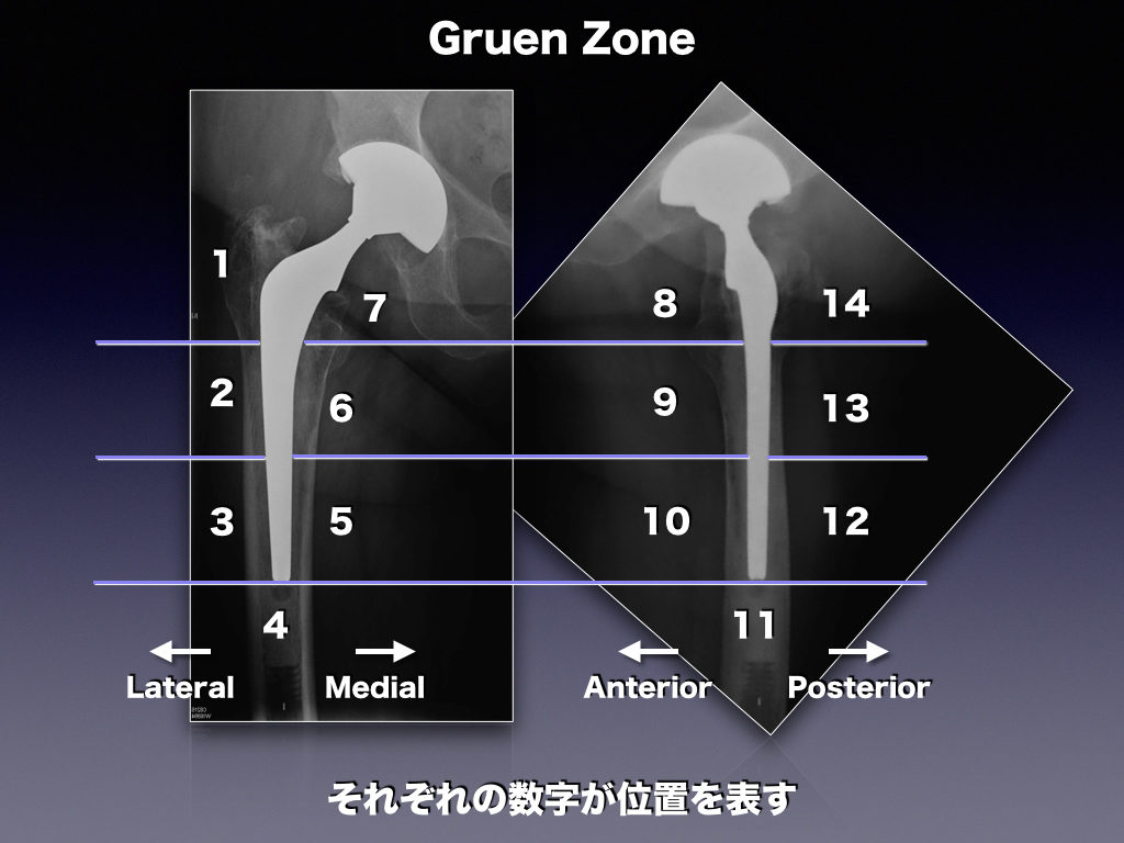 Hip Prosthesis Zoneを知ろう │ 整形外科のいろいろ