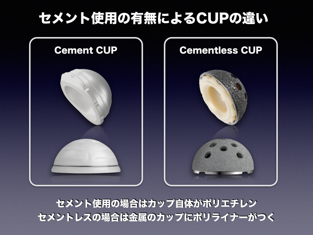 カップの基礎知識1 │ 整形外科のいろいろ