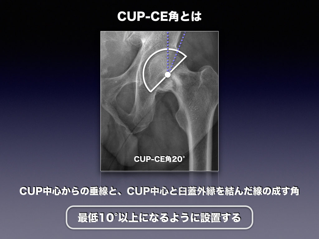 THA-CUPテンプレート1 │ 整形外科のいろいろ