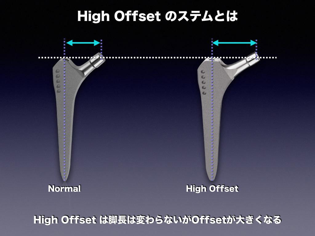 THA-CUPテンプレート2 │ 整形外科のいろいろ