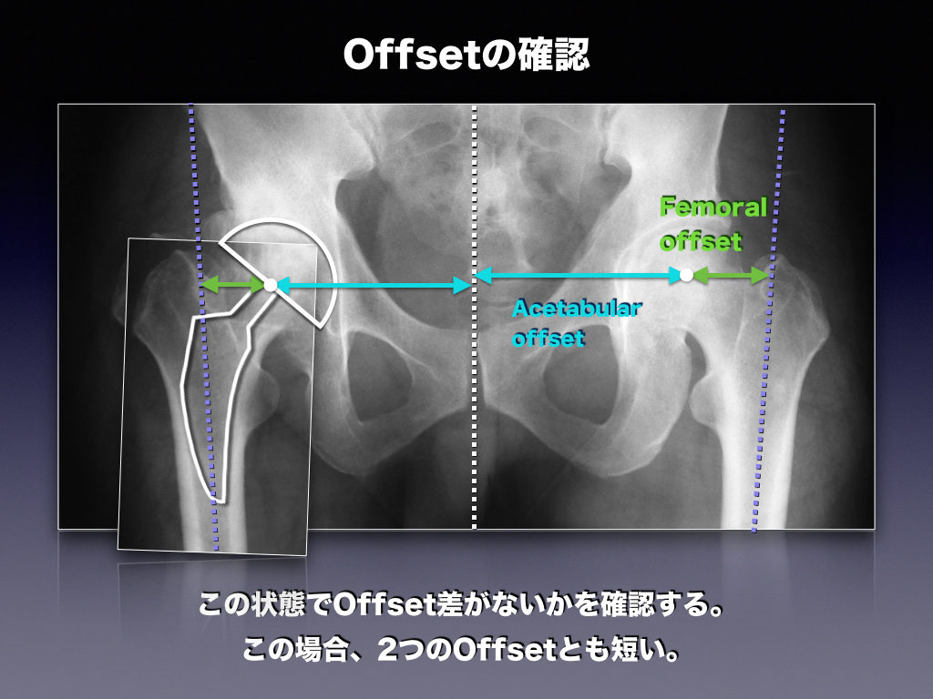 THA-CUPテンプレート2 │ 整形外科のいろいろ