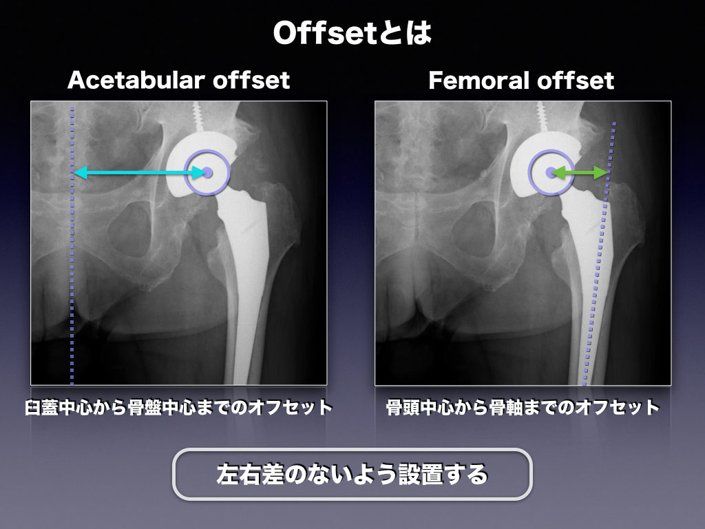 THA-CUPテンプレート1 │ 整形外科のいろいろ