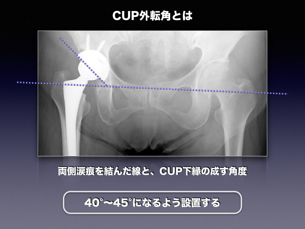 THA-CUPテンプレート1 │ 整形外科のいろいろ