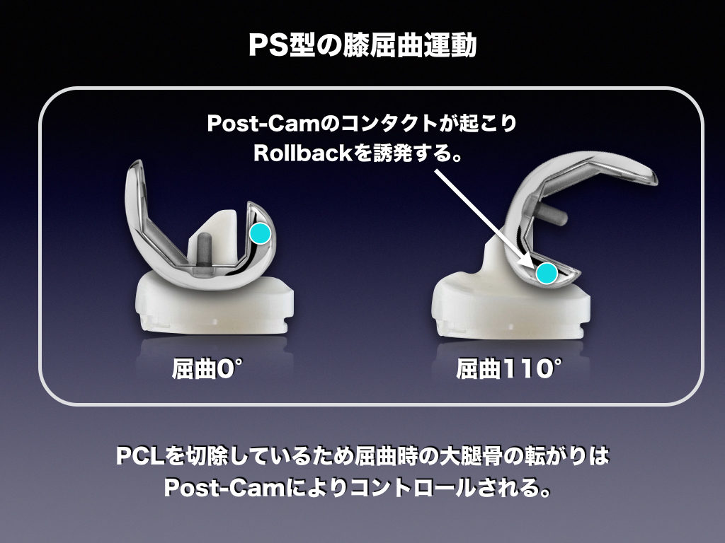 TKA-PS型とは │ 整形外科のいろいろ