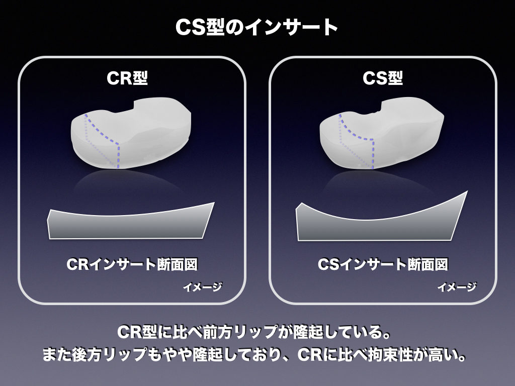 TKA-CS型・BCP型とは │ 整形外科のいろいろ