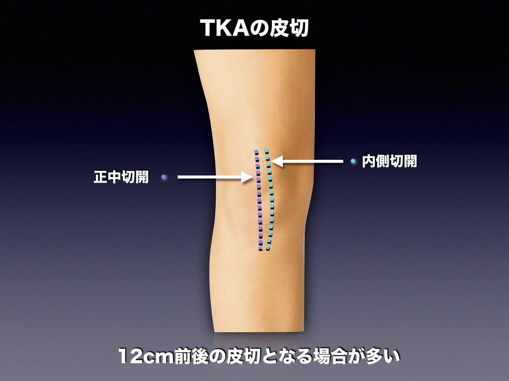 Lateral Parapatellar Approachとは │ 整形外科のいろいろ