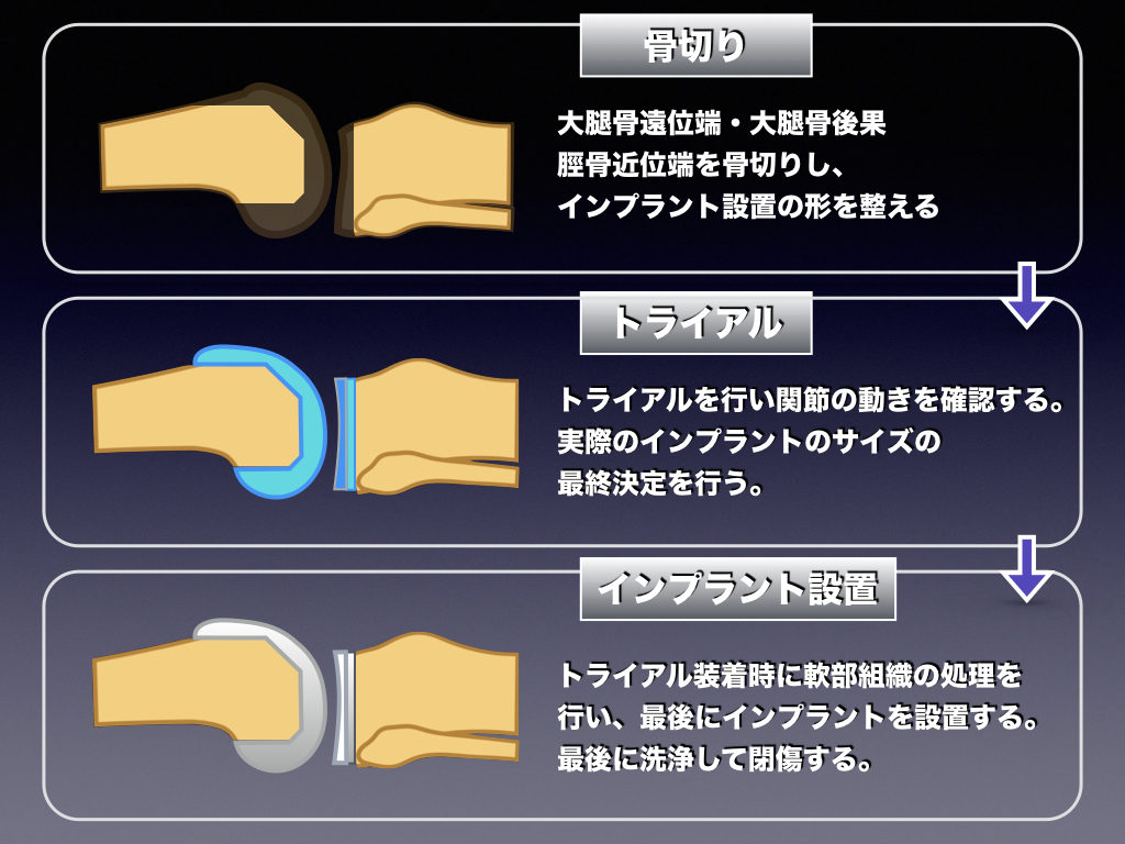 TKA手術の概要 │ 整形外科のいろいろ